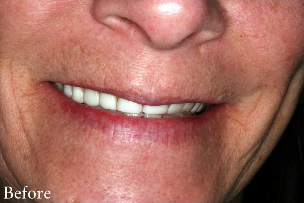 Smile Gallery - Dentist Office In Louisville, KY - Natural Smiles